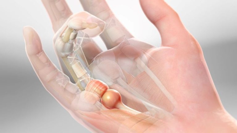 Dermoid Cyst Finger Surgical Removal Recovery Tips - Spreads Hub